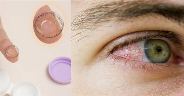 Đeo lens bị đỏ mắt: Nguyên nhân do đâu và cách hạn chế hiệu quả